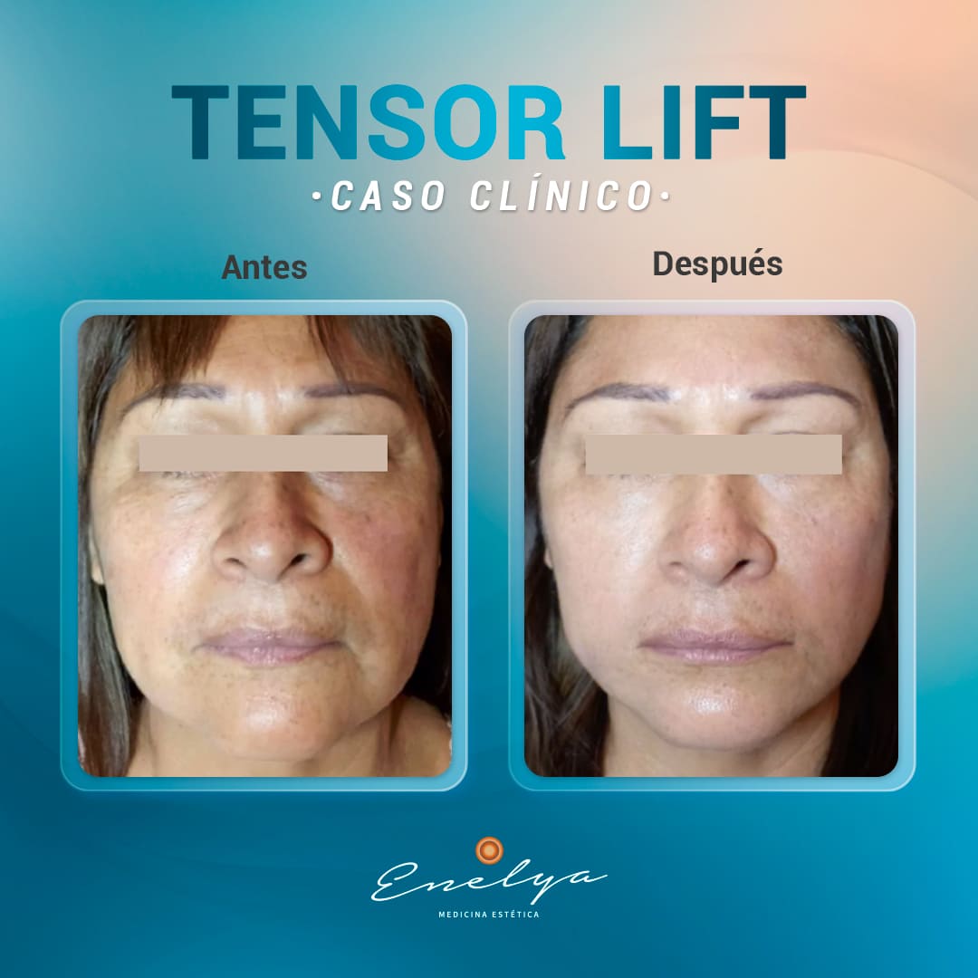 Rejuvenecimiento Facial – Enelya